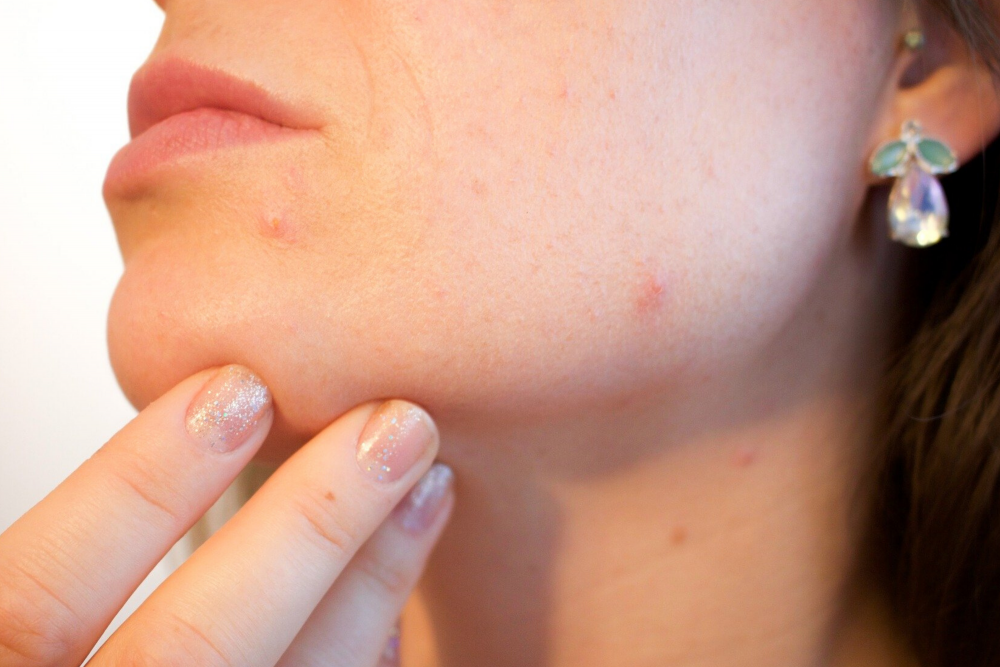 Das ist die beste Behandlung gegen Akne-Narben / MES