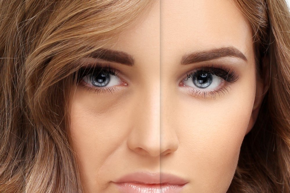 BLEFARO NON CHIRURGICA / MES